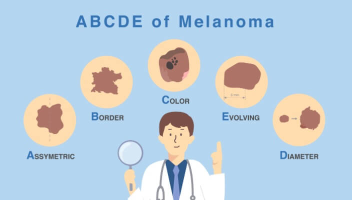 Melanoma: A Deadly Skin Cancer And How To Spot It Early - Daylifenews